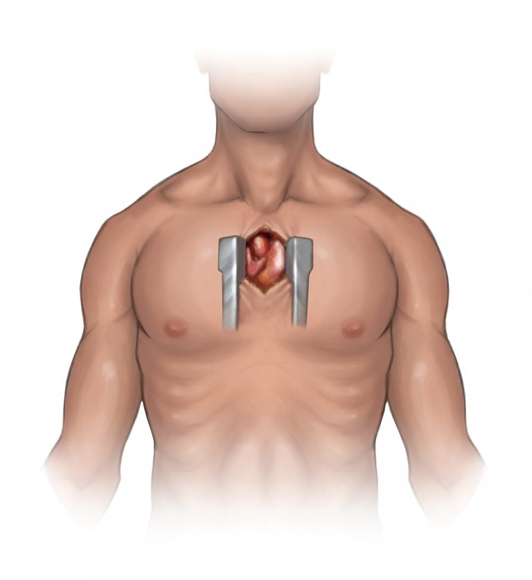 What Is Keyhole Heart Surgery? - The Keyhole Heart Clinic