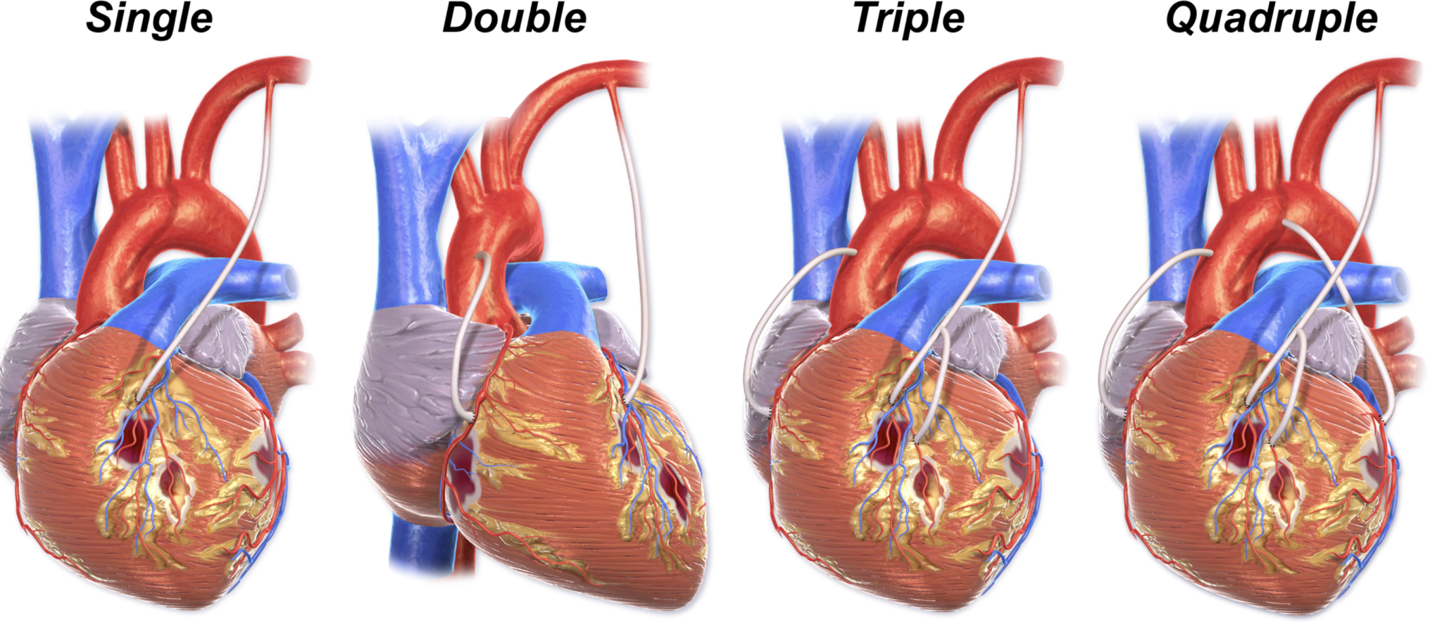 What Is A Coronary Artery Bypass Graft? Learn More Online