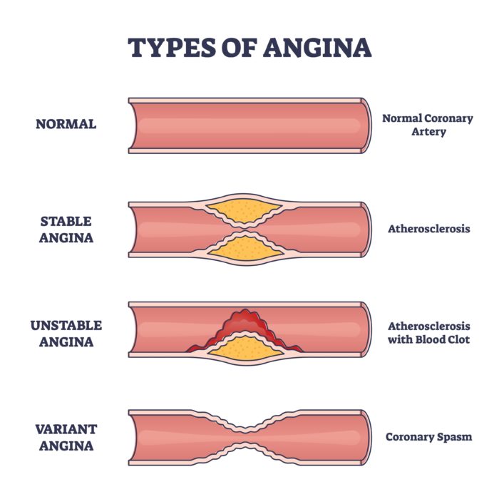 Angina Treatment Symptoms The Causes Of Angina Angina Treatment Symptoms The Causes Of Angina