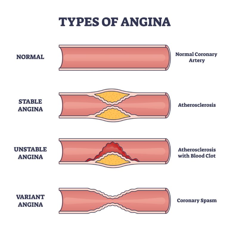 Angina Treatment & Symptoms, The Causes of Angina