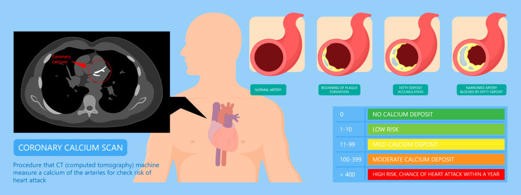 CT Coronary Angiogram Explained | The Keyhole Heart Clinic